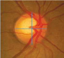 FIve Points You Must Note While Examining An Optic Disc